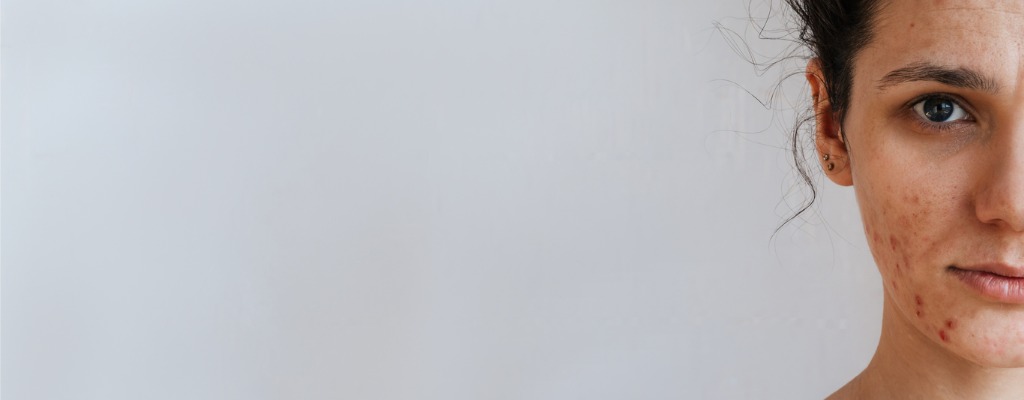 Breaking the stigma: Understanding and treating adult acne